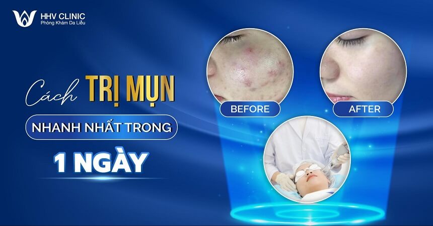 TOP 15 Cách trị mụn nhanh nhất trong 1 ngày tại nhà